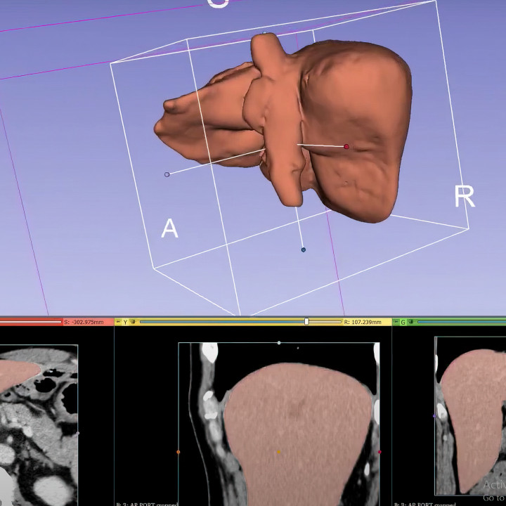 3D Printable convert your CT / MRI scans to 3d printable file by Asem ...