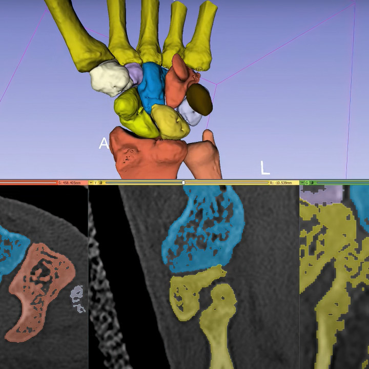 3D Printable convert your CT / MRI scans to 3d printable file by Asem ...