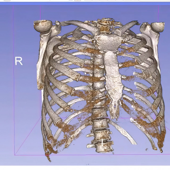 3D Printable convert your CT / MRI scans to 3d printable file by Asem ...