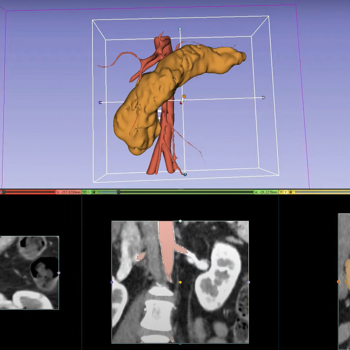 3D Printable convert your CT / MRI scans to 3d printable file by Asem ...