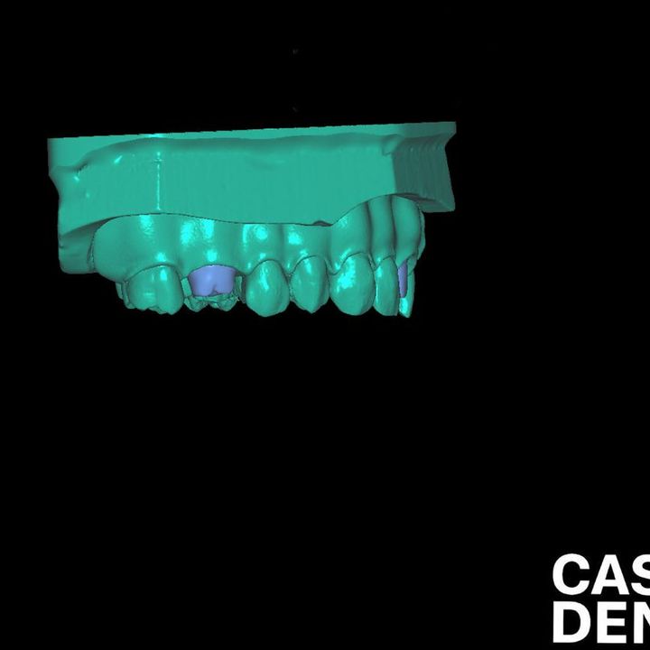 3D Printable Tooth Preparation Models – Central, Premolar, Molar | Cut ...